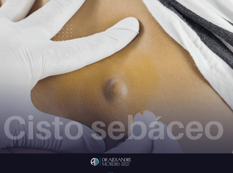 "Cistos sebáceos: o que são, causas e métodos de remoção" - Dr ...