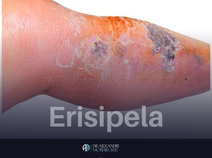 "Erisipela: O Que é, Causas, Sintomas e Tratamentos" - Dr.Alexandre ...