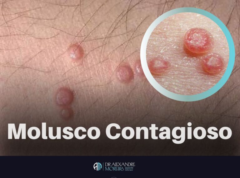 Tudo sobre o Molusco Contagioso: Causas, Sintomas e Tratamentos na ...
